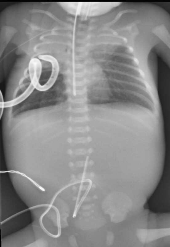 Spotlight on Safety Story: Oesophageal Perforation | British ...