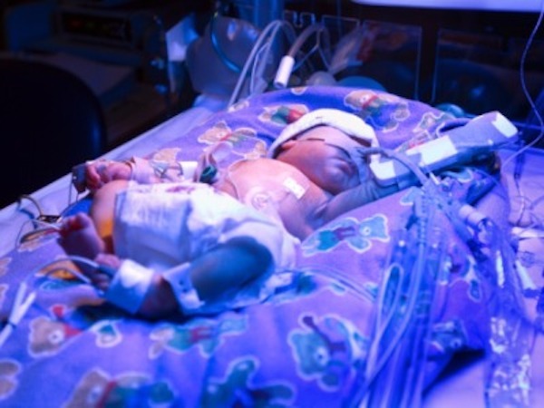 The Management of Babies Born Extremely Preterm at less than 26 weeks ...